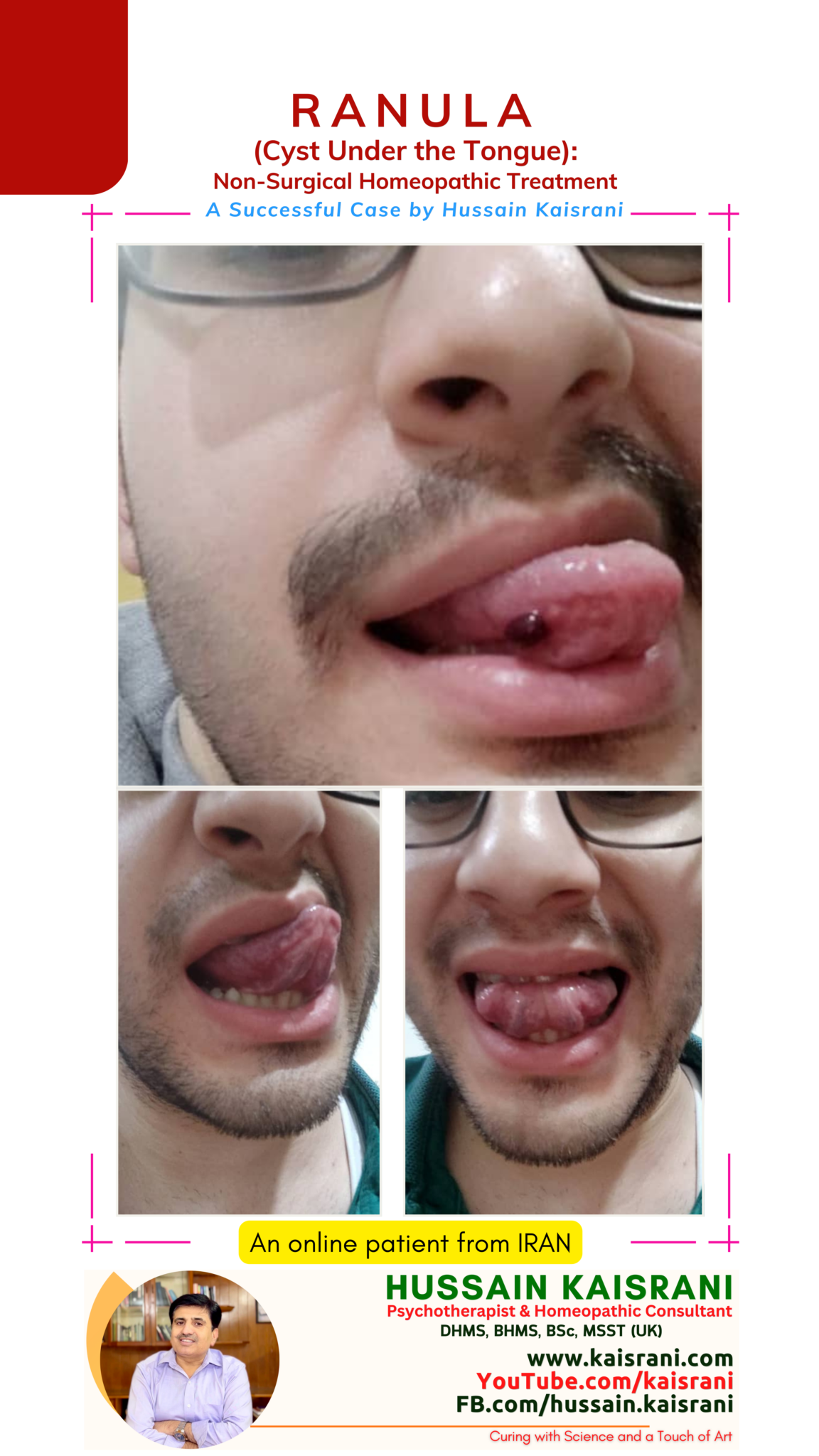 RANULA (Cyst Under the Tongue): Non-Surgical Homeopathic Treatment – A Successful Case by ...