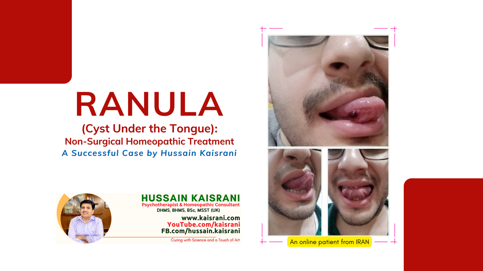 RANULA (Cyst Under the Tongue): Non-Surgical Homeopathic Treatment – A Successful Case by ...