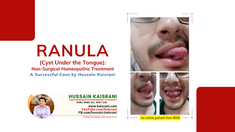 RANULA (Cyst Under the Tongue): Non-Surgical Homeopathic Treatment – A ...